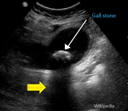 GB stone – NephroPOCUS