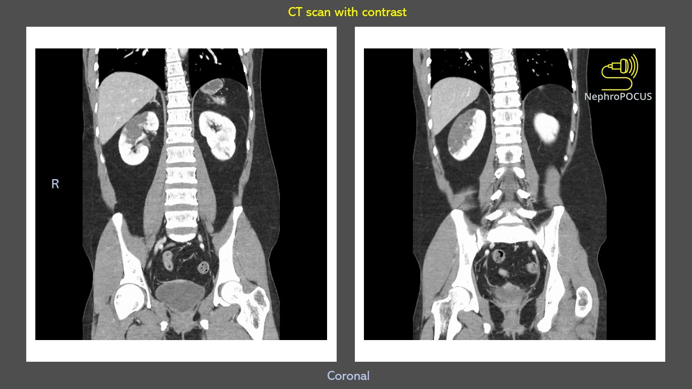 Renal infarction – NephroPOCUS