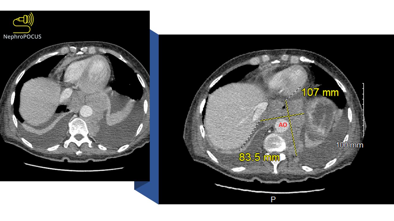Peri-aortic lymphoma seen on echocardiogram – NephroPOCUS