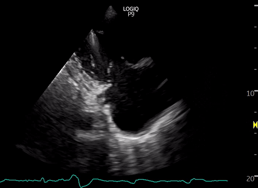 The RV inflow view – NephroPOCUS