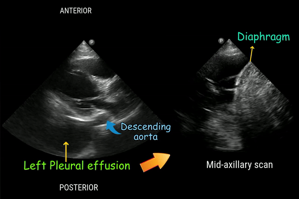 Pericardial versus pleural effusion on PLAX view – NephroPOCUS