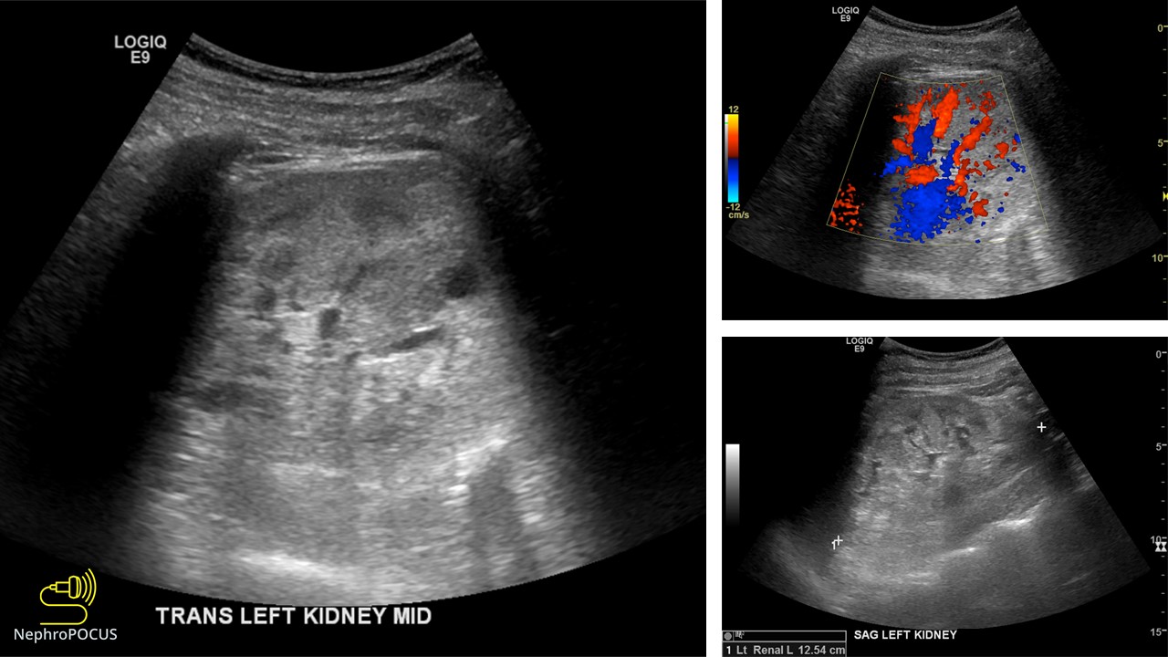 Two young patients with increased renal cortical echogenicity – NephroPOCUS