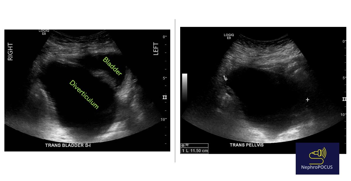 Urinary bladder diverticula – The Mickey Mouse sign – NephroPOCUS
