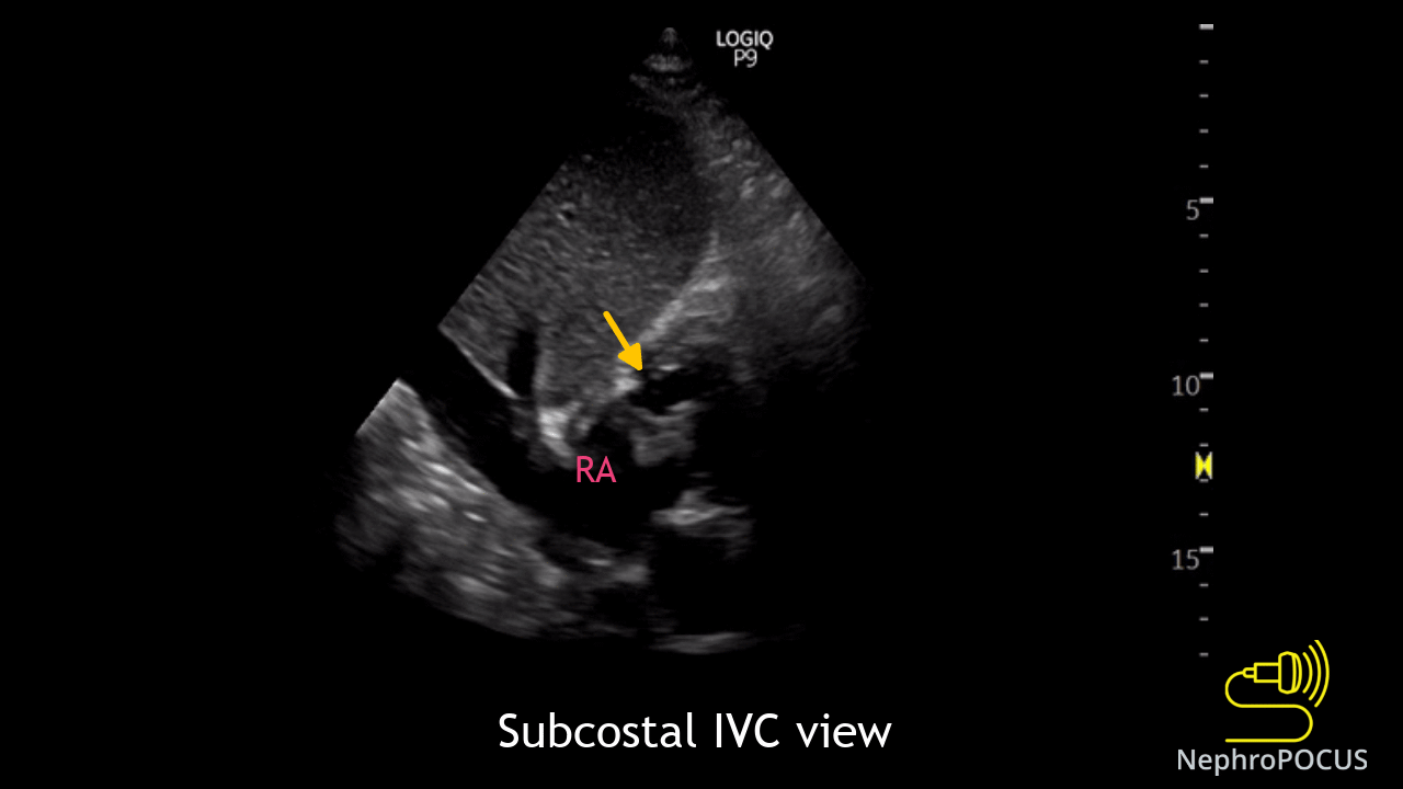 Subxiphoid Ivc View Beyond Estimation Of Right Atrial Pressure