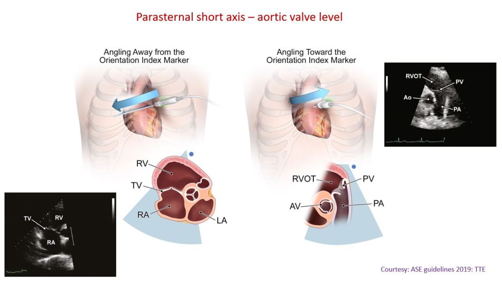 Infographics – NephroPOCUS