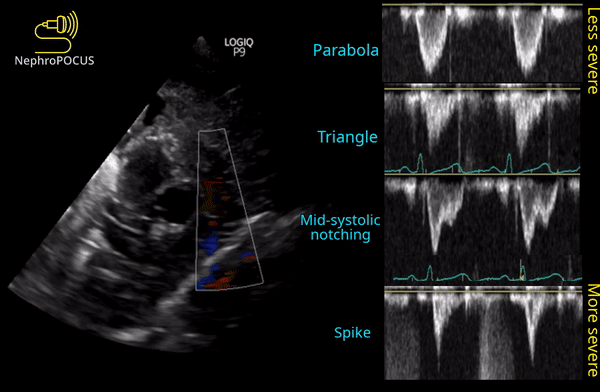 Infographics – NephroPOCUS