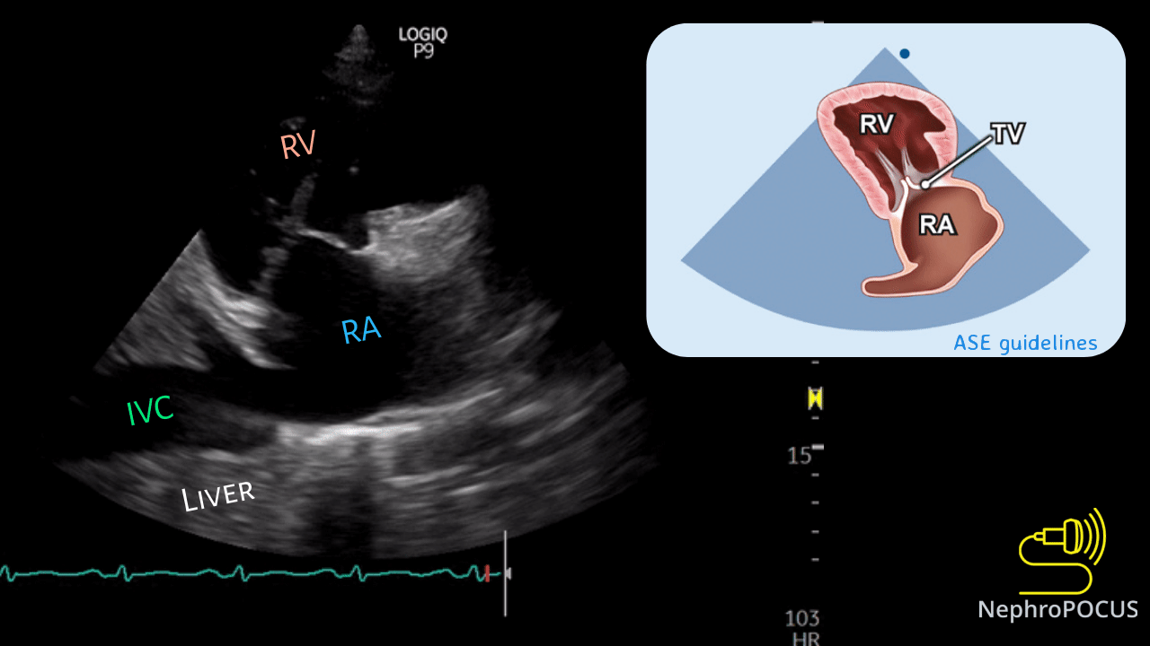 The RV inflow view – NephroPOCUS