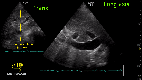 Ivc Collapse Fact Or Artifact Nephropocus