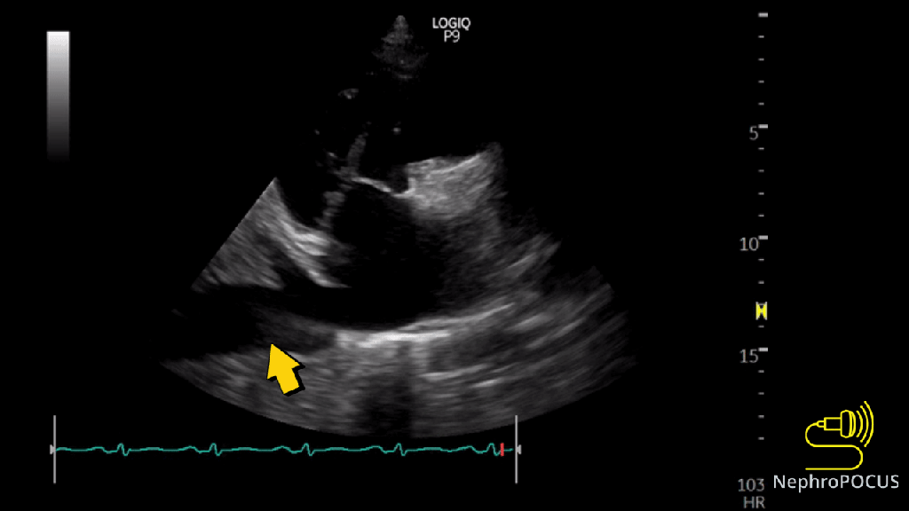 The RV inflow view – NephroPOCUS