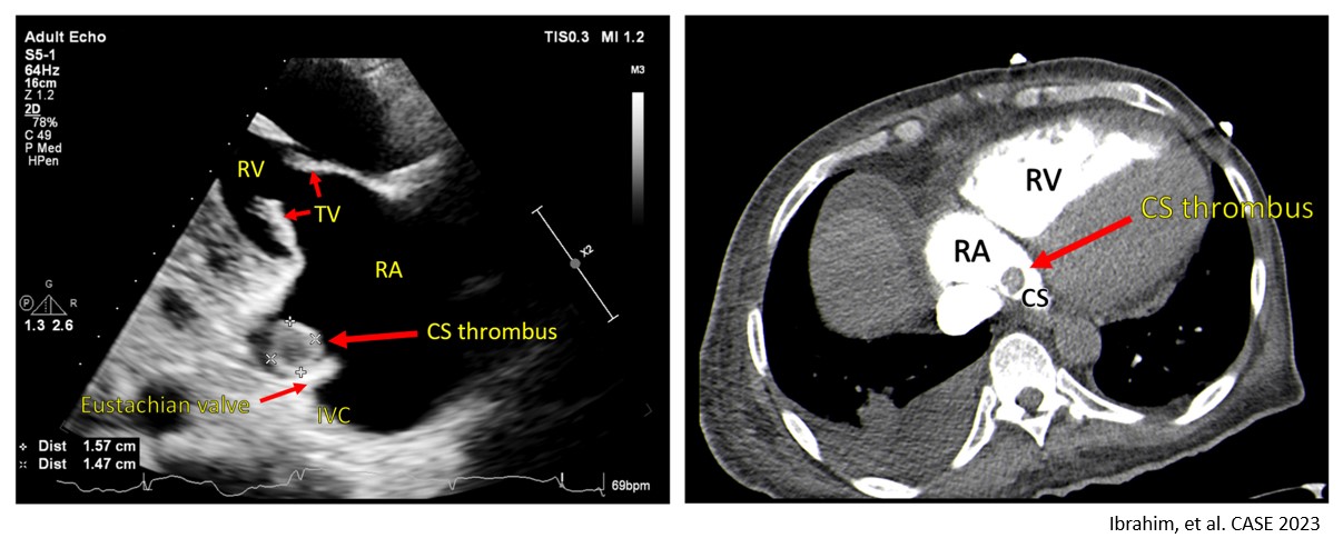 The RV inflow view – NephroPOCUS