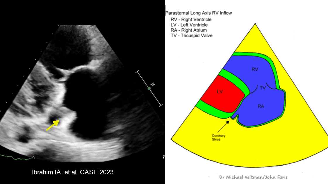 The RV inflow view – NephroPOCUS